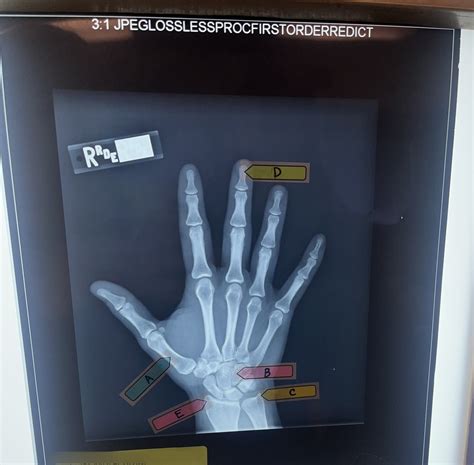 X Ray 6 Diagram Quizlet