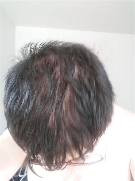 20m Diffuse Thinning Since 9 Years Ago Rmalehairadvice