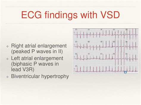 Vsds And Asds Ucsf Congenital Cardiac Anesthesia Tutorials Ppt Download