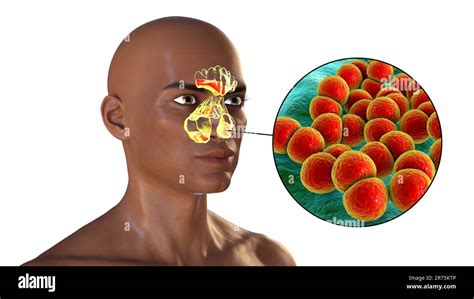 Sinusite bactérienne illustration informatique Les sinus sont des