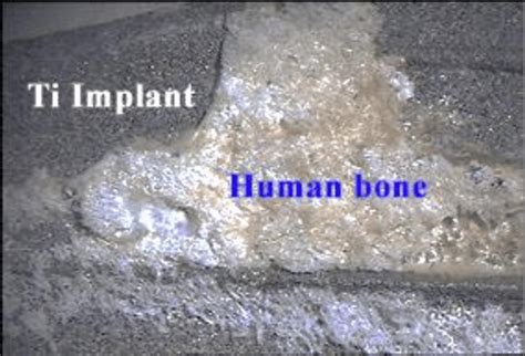 Growth Of Human Bone Osseointegration On A Plasma Sprayed Titanium Download Scientific