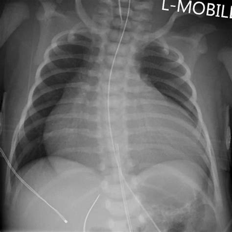 Ebstein Anomaly Radiology Case Radiopaedia Org Ebstein S Anomaly