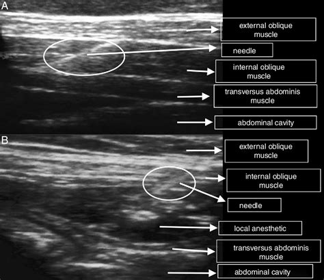 Figure 1 From Ultrasound Guided Transversus Abdominis Plane Block In Patients Undergoing