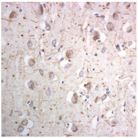 Nuclear Carrier And Rna Binding Proteins In Frontotemporal Lobar