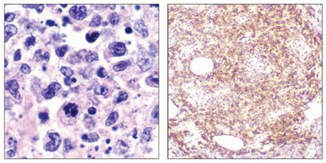 Myeloid Monocytic Sarcoma Basicmedical Key