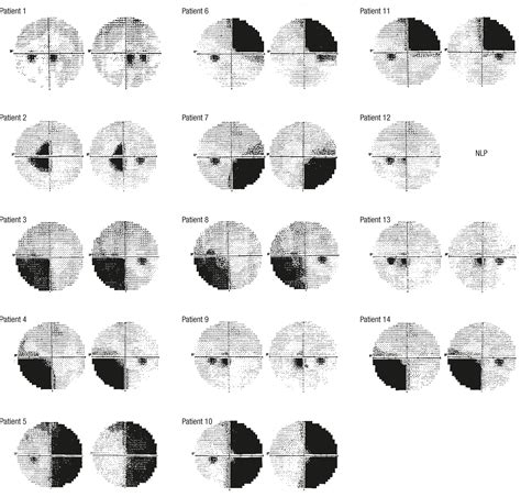 Inferior Temporal Visual Field Defect