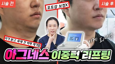 빅맥이중턱 고민인 사람 주목 아그네스로 확실하게 리프팅하자 시술 2개월 후 경과 공개 Youtube