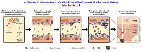 Nephrolithiasis Pathophysiology Diagram