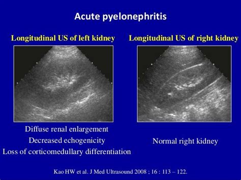 Acute Pyelonephritis Radiology Imaging Medical Imaging Diagnostic