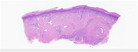 Figure 1 From Cholesterol Embolization Syndrome Post Invasive Arterial