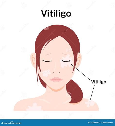 Symptoms Of Vitiligo Vector Illustration Stock Vector Illustration Of