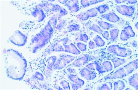 Gastric Duplication The Duplications In The Mucosal Layer With Gastric