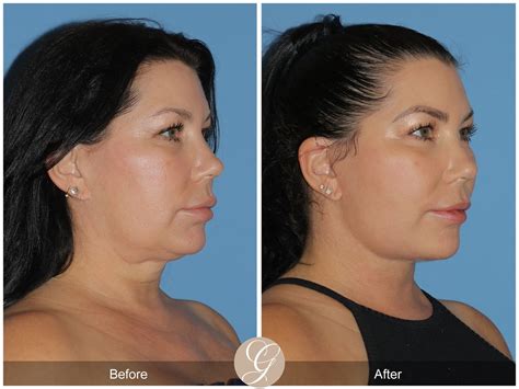 Deep Plane Facelifts Before And After Photos From Dr Kevin Sadati