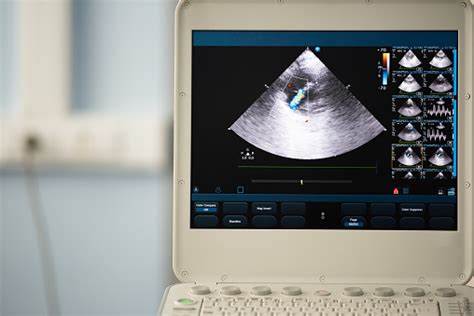 심장 검사의 이미지와는 초음파 스캐너의 화면 사진 어디에 판 막 병 역류 도플러 메서드를 사용 하 여 평가 하 게 됩니다 건강