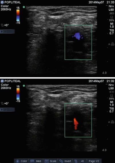 Popliteal Sciatic Nerve Block Anesthesia Key