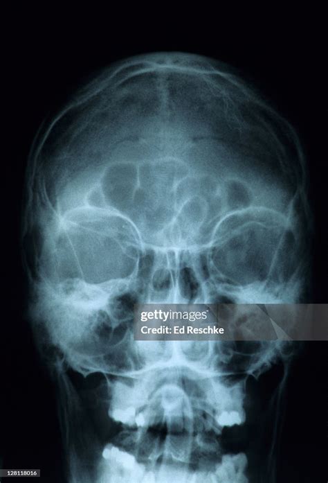 Orbits X Ray Radiologic Imaging Shows Variable Accuracy In Diagnosing