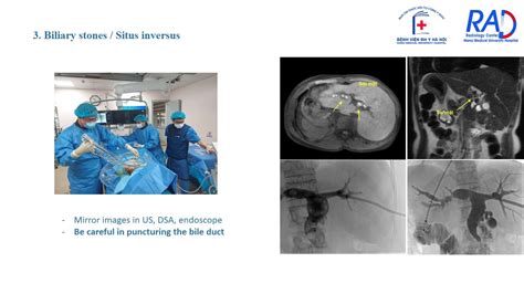 Percutaneous Transhepatic Laser Lithotripsy In Treatment Of Biliary Stone
