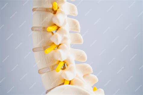 Premium Photo Lumbar Spine Displaced Herniated Disc Fragment Spinal