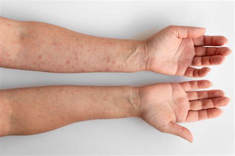 Queratose Pilar Causas Sintomas E Tratamentos