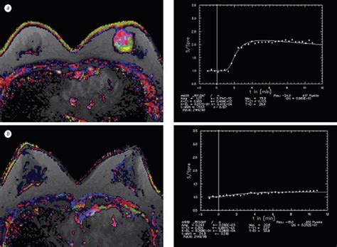 Mri Based Perfusion Map In Breast Cancer A High Perfusion Indicated