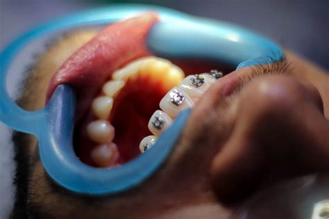 Zobni Aparat Za Ravnanje Zob Drustvo Kid Si