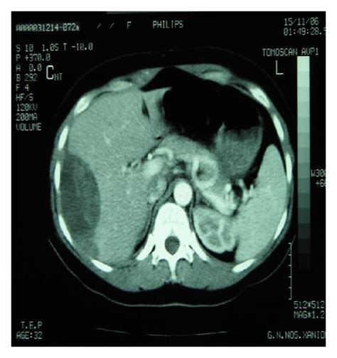 Abdominal Computed Tomography Demonstrating The Existence Of A Large