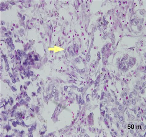 Pas Positive Hyaline Bodies Pas Stain 400× Download Scientific