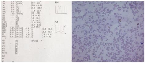 The Rbc Histogram Shows Macrocytosis With A Shift To The Right And A