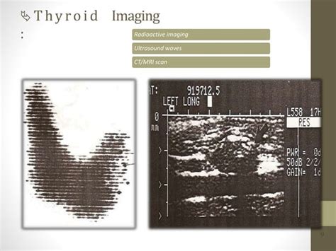 Thyroid And Parathyroid Pptx