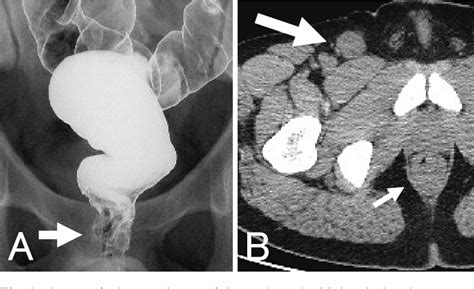 Figure From Outcomes Of Inguinal Node Dissection For Metastases From Anal Canal Carcinoma