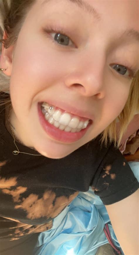 15 Week Progress For Deep Overbitecrowding Rinvisalign