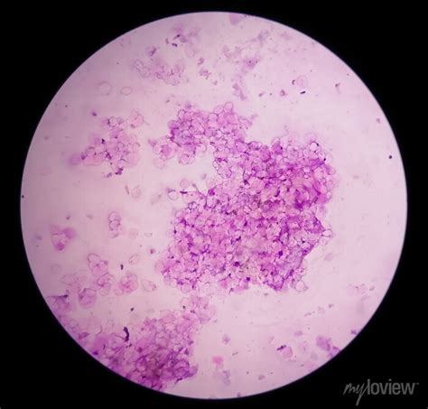 Microscopic Analysis Showing Epidermal Inclusion Cyst Swelling • Wall