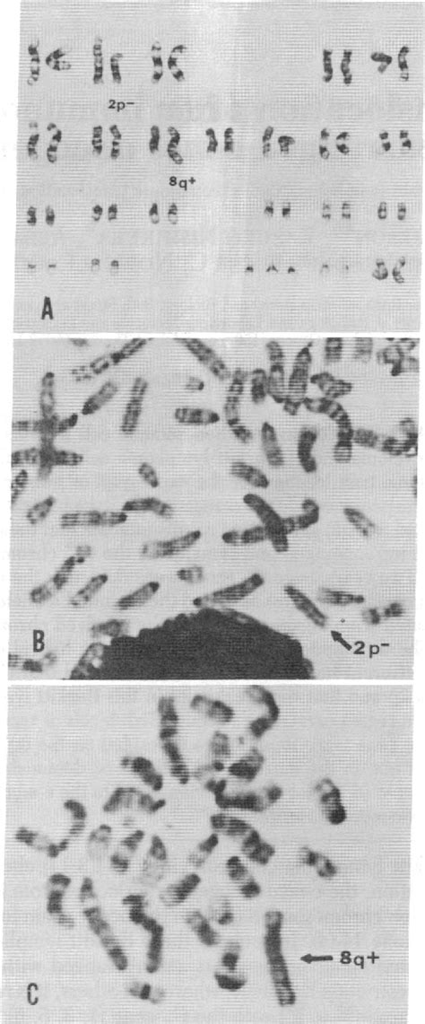 Figure 1 From Translocation Of An Immunoglobulin Kappa Locus To A Region 3 Of An Unrearranged C