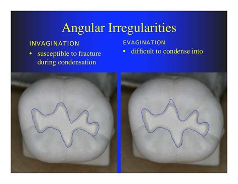 Class I Amalgam Cavity Design
