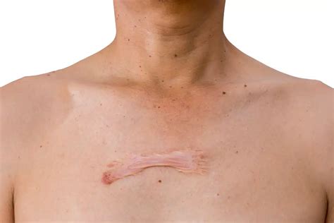 Effective Strategies For Chest Keloid Removal