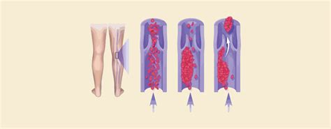 Chronic Venous Insufficiency Vs Deep Vein Thrombosis Navigating