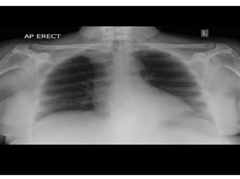 Chest X Ray Interpretation Pdf