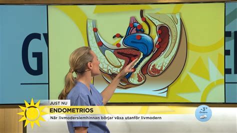 Gynekologen om endometrios Menssmärtor jämt kroniskt Nyhetsmorgon TV YouTube