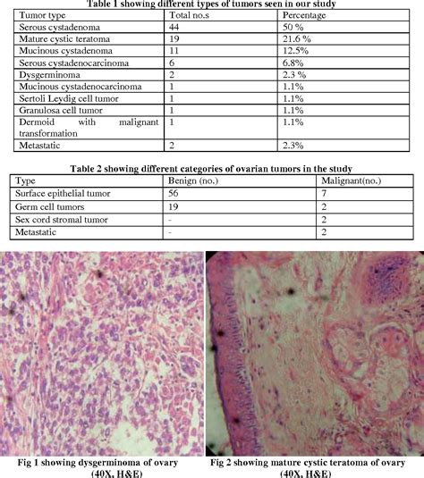 Small Cell Lung Cancer Metastasis To Brain Life Expectancy