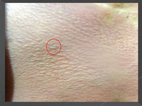 Papular Mucinosis