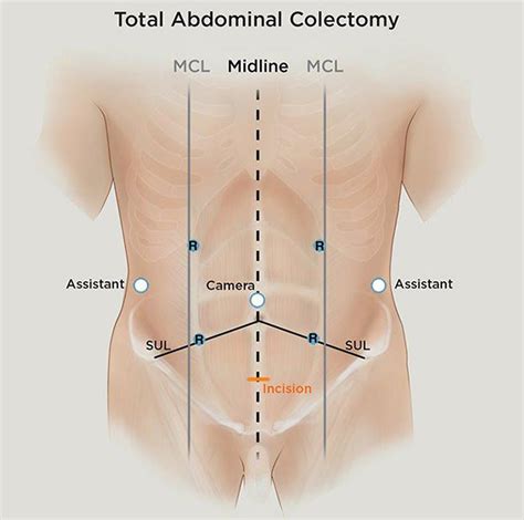 Trocar Positioning In The Abdominal Wall For Robotic Total Colectomy