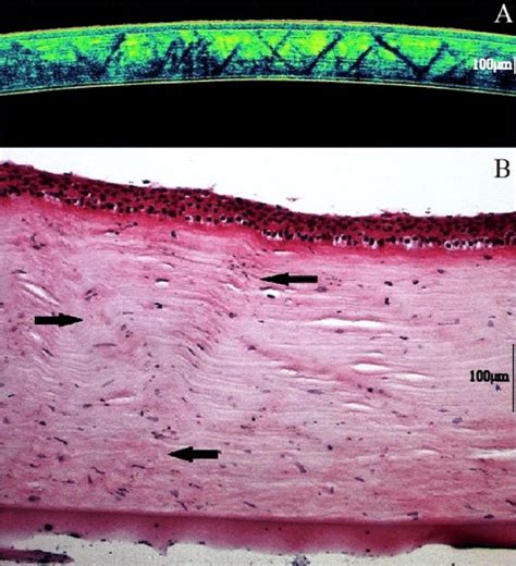 Optical Coherence Tomography Image A Of Corneal Stromal Striae