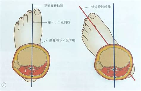 News Hybrid External Fixation Brace For Closed Reduction Of Tibial Plateau Fracture