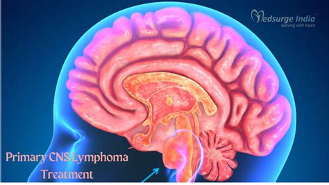 Primary CNS Lymphoma Treatment Cost In India Medsurge India