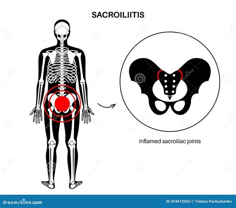 Sacroiliitis Medical Poster Stock Vector Illustration Of Medical