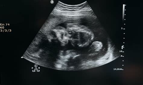 Fetal Dna Çocukludünya Blog