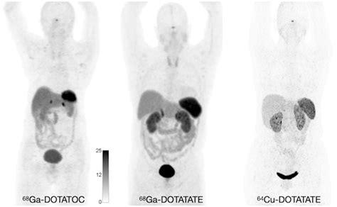SNMMI Issues New Guideline For PET Imaging Of Neuroendocrine Tumors