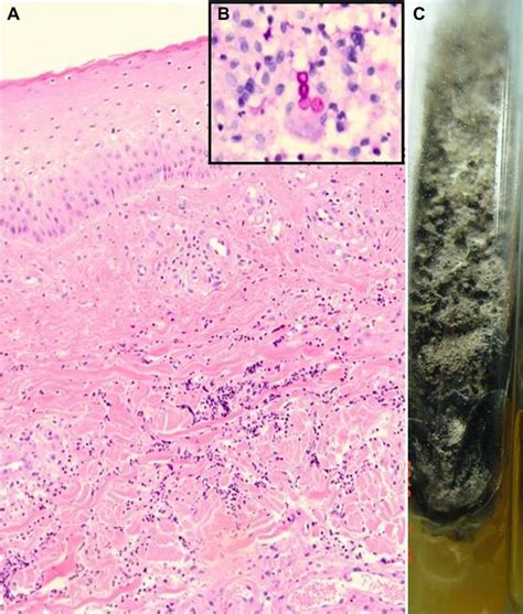 A There Were Marked Neutrophilic Infiltrates Primarily In The Download Scientific Diagram