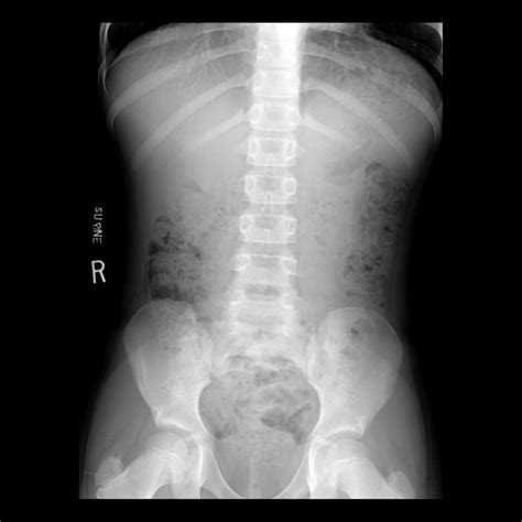 Pediatric Constipation Pediatric Radiology Reference Article Pediatric Imaging Pedsimaging