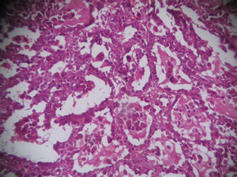 Medullary Carcinoma Thyroid Histopathologyguru